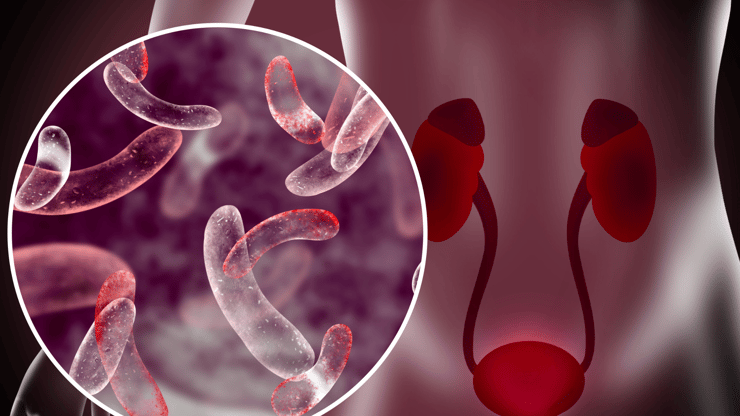 Urinary Tract Infection NCLEX Review for Nursing Students Urinary Tract Infection NCLEX Review for Nursing Students